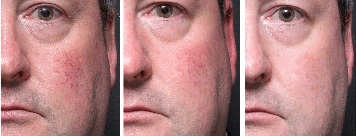 Rosacea treatment - Esteva Clinic