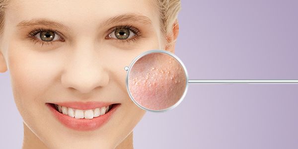 Removal of milia in Kyiv - treatment of millet: prices, reviews, photos ...