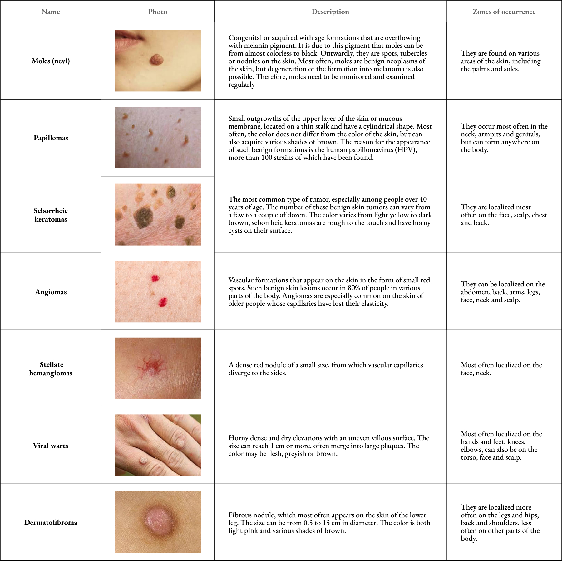 Benign Benign Tumor Aas Ayurveda Benign Benign Tumor Aas Ayurveda