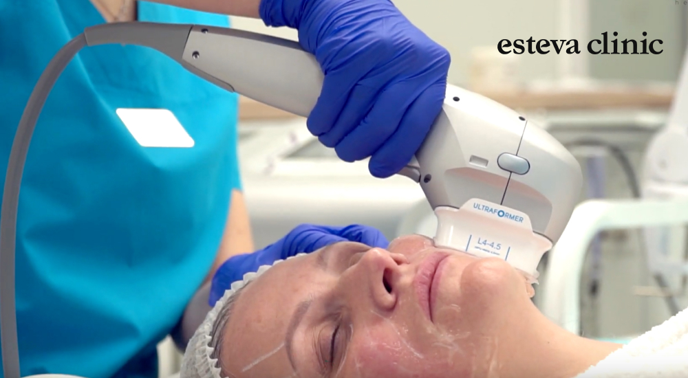 Is SMAS lifting suitable if I have had meson threads installed