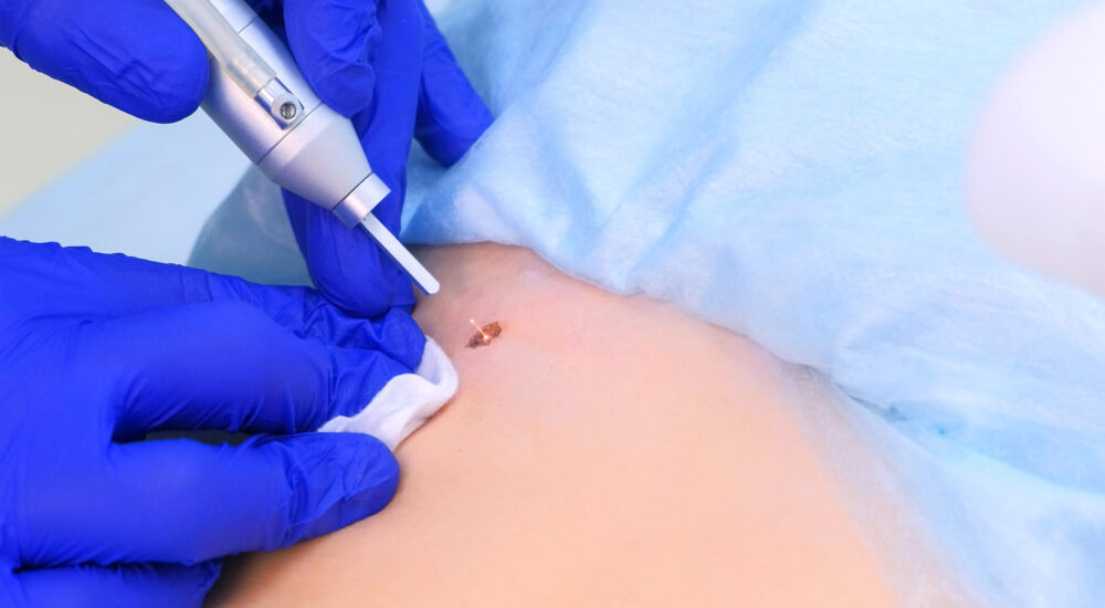 Cryotherapy (freezing). Removal of genital warts is carried out with ...