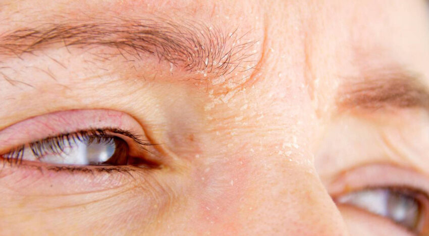 One or more of the following factors can provoke the onset of the disease: